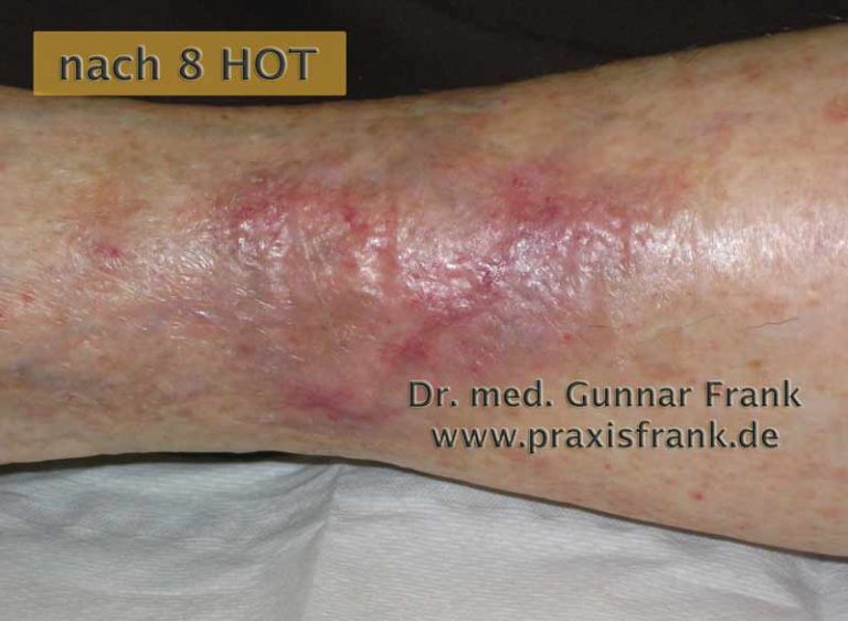 Offenes Bein / Ulcus cruris behandeln mit Sauerstofftherapie - Fallbeispiel